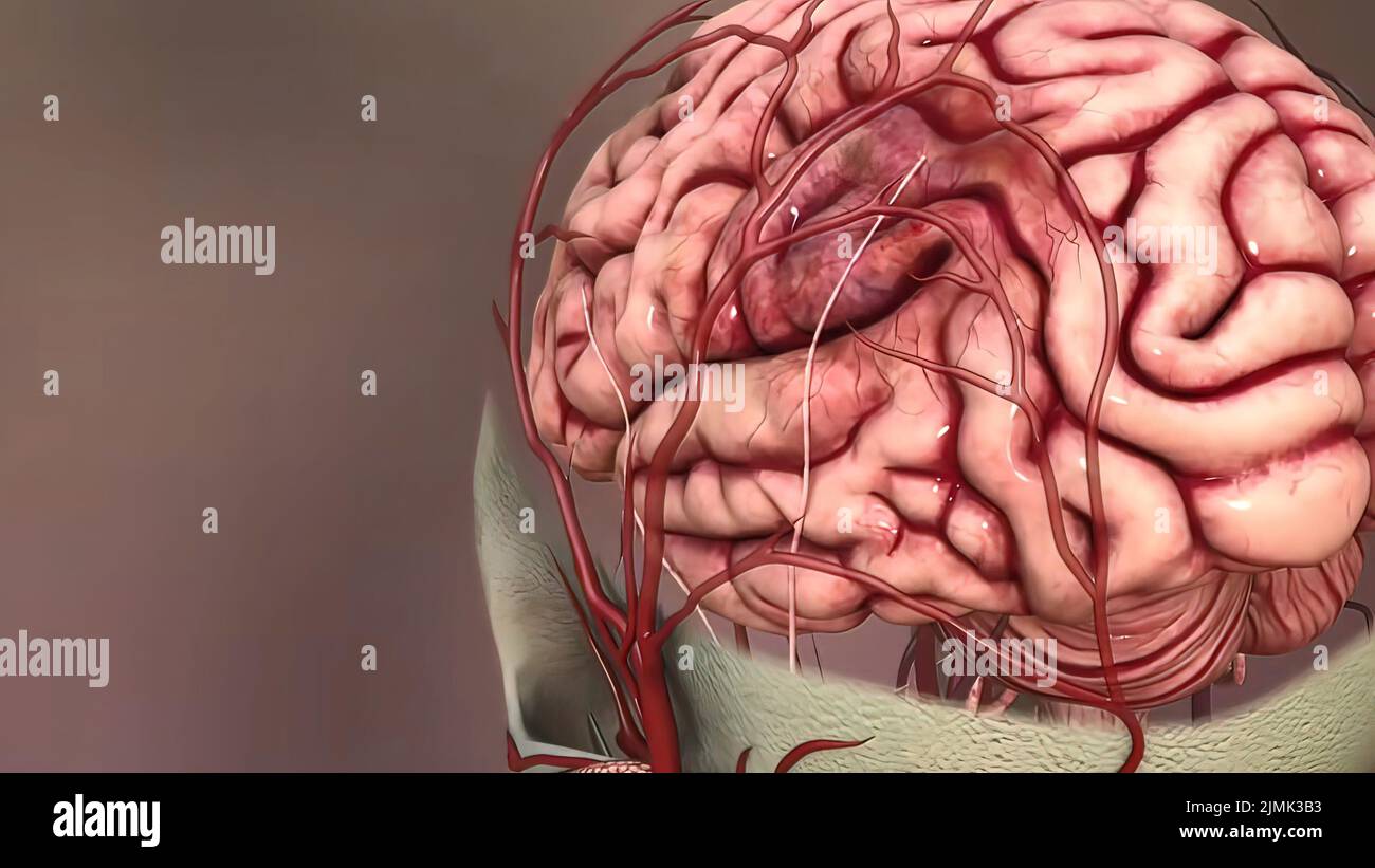 Embolism and blood clot brain hi-res stock photography and images - Alamy