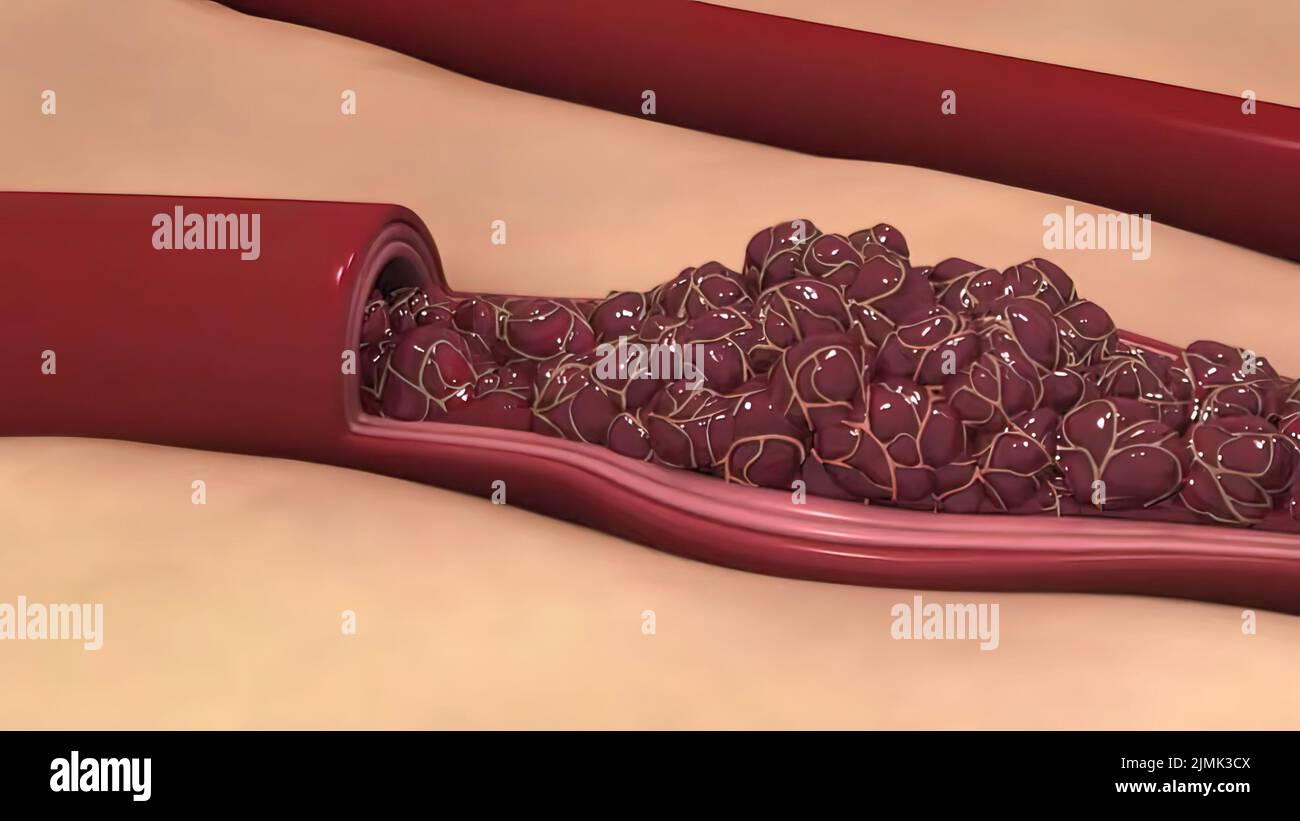 Blood vessels brain hi-res stock photography and images - Alamy