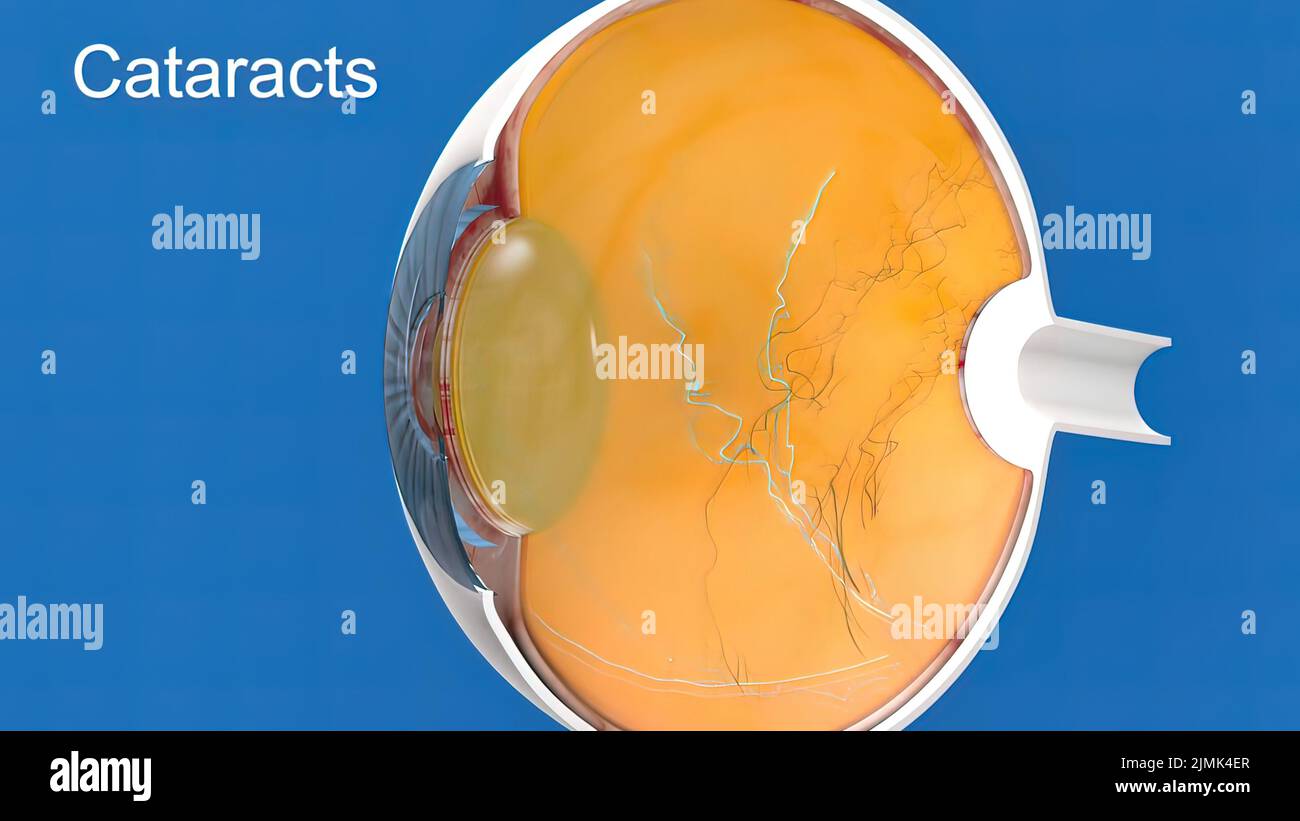 Hazy cornea hi-res stock photography and images - Alamy
