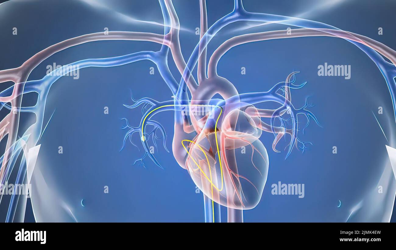 Coronary angiogram stent hi-res stock photography and images - Alamy