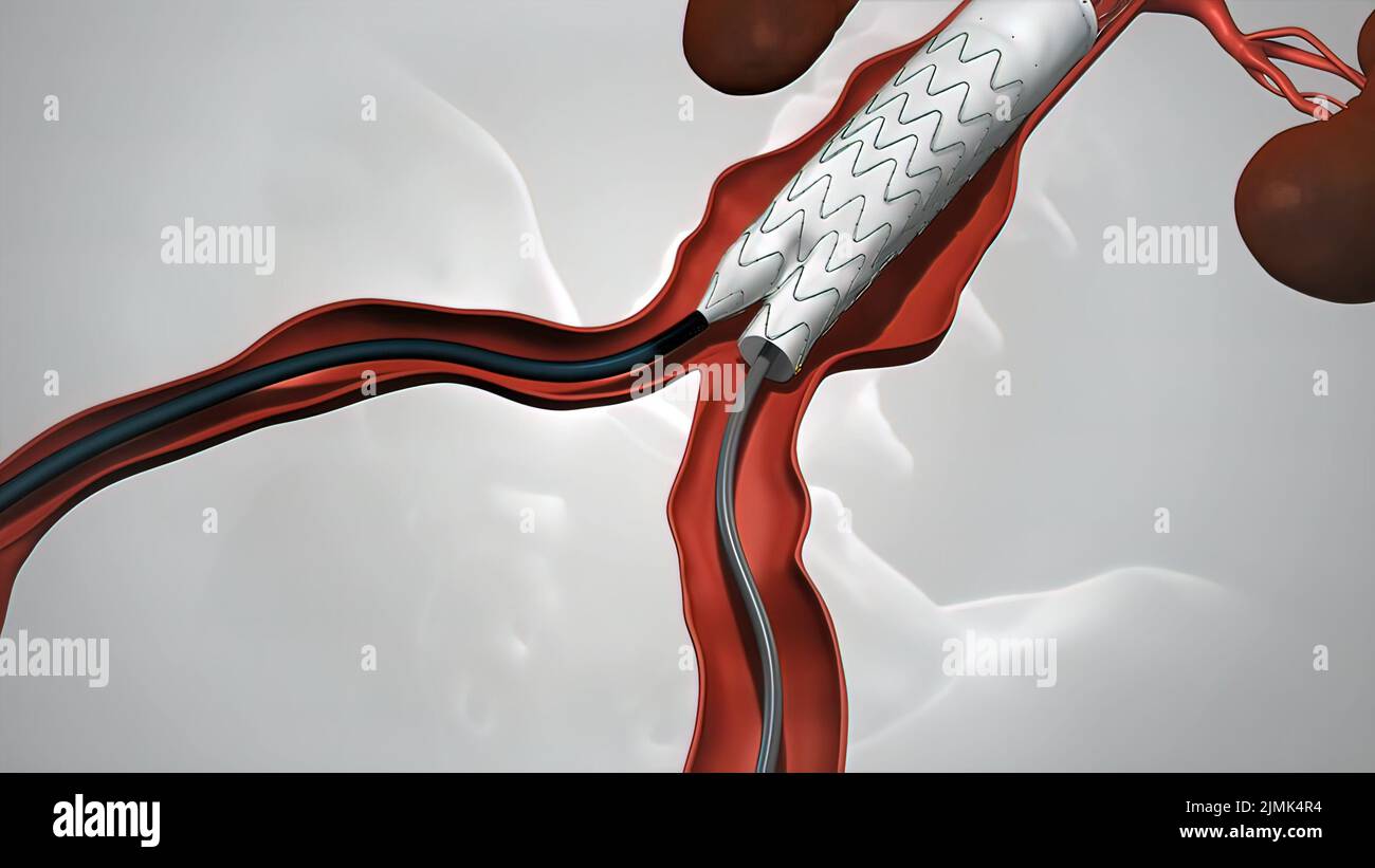 Arteriosclerosis stent procedure hi-res stock photography and images ...
