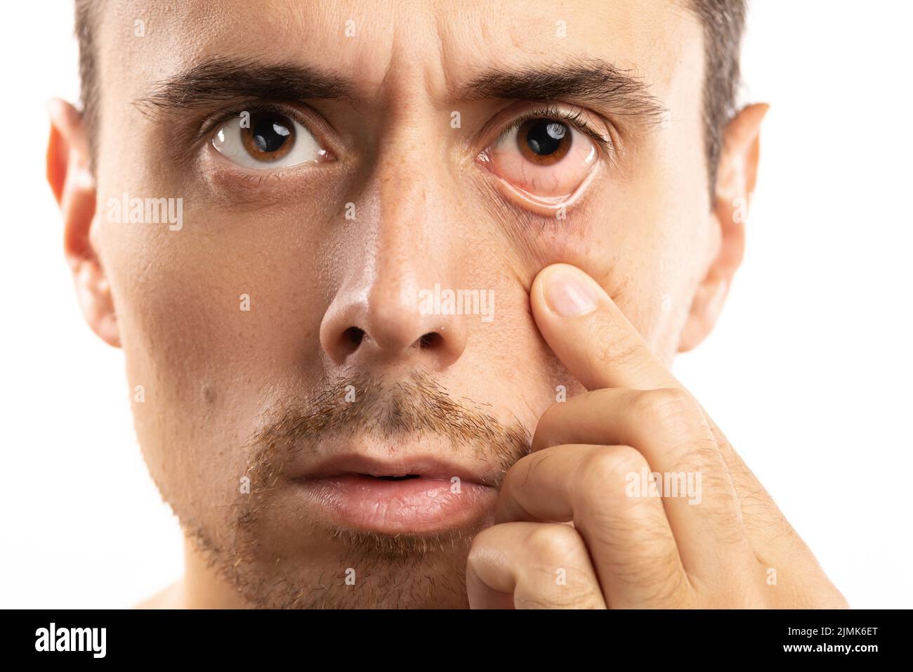 Corneal disease hi-res stock photography and images - Alamy