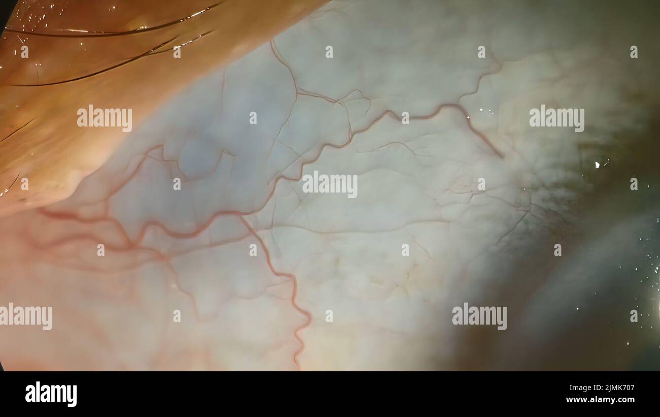 Tortuous Veins Eyes Clipart