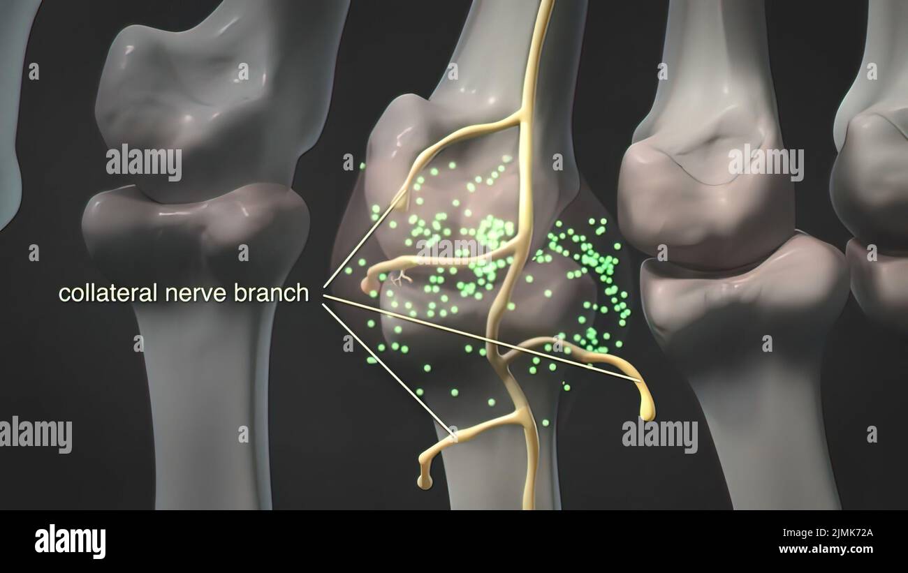 Middle collateral artery hi-res stock photography and images - Alamy