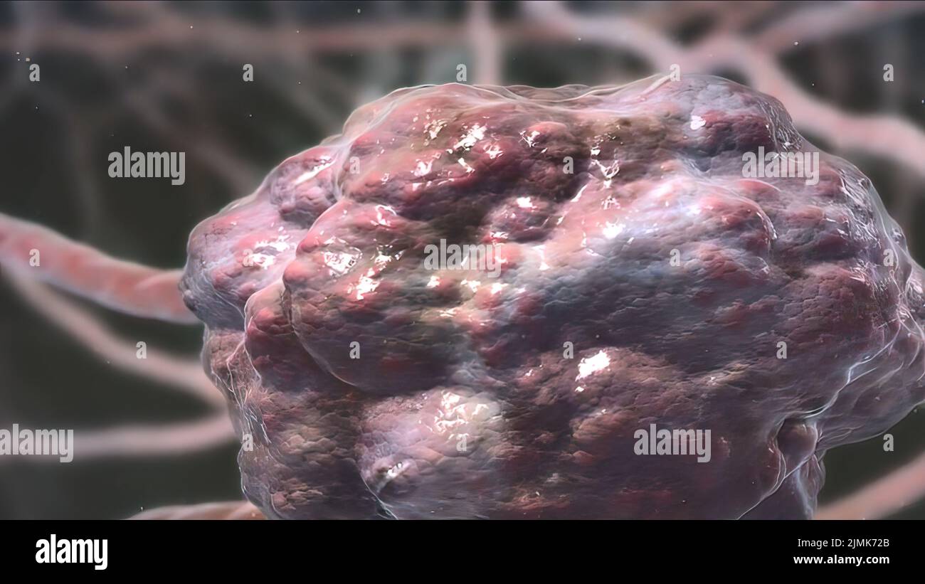 Cáncer vascular hi-res stock photography and images - Alamy