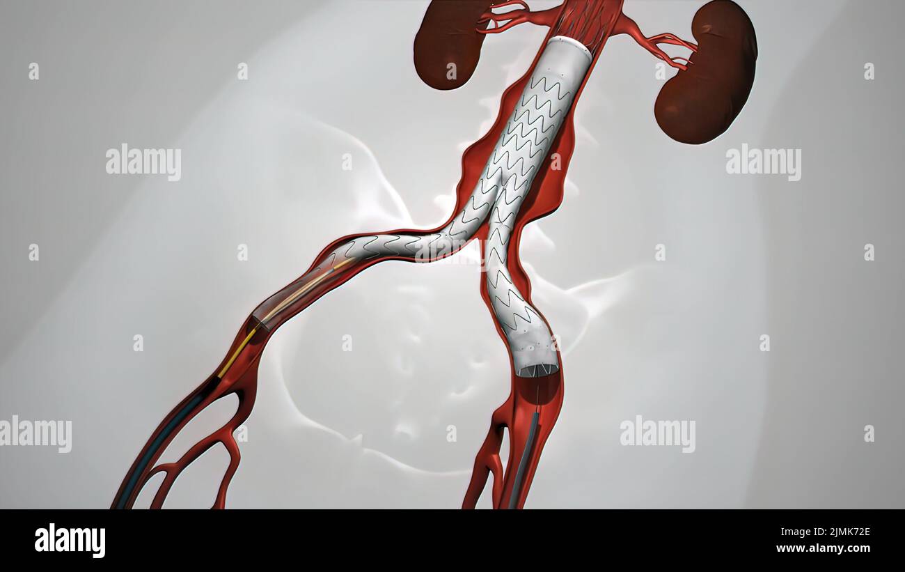 Arteriosclerosis stent procedure hi-res stock photography and images ...