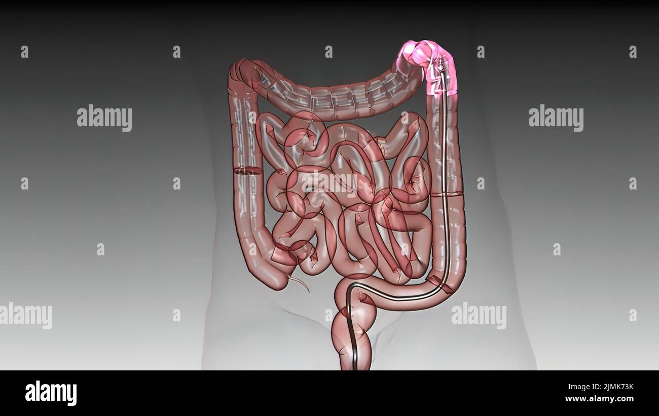 Large intestine camera hi-res stock photography and images - Alamy
