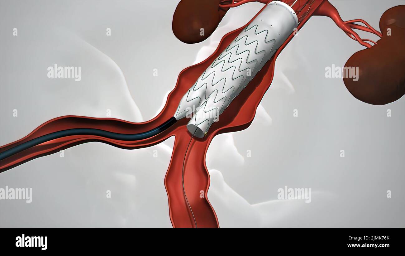 Arteriosclerosis stent procedure hi-res stock photography and images ...