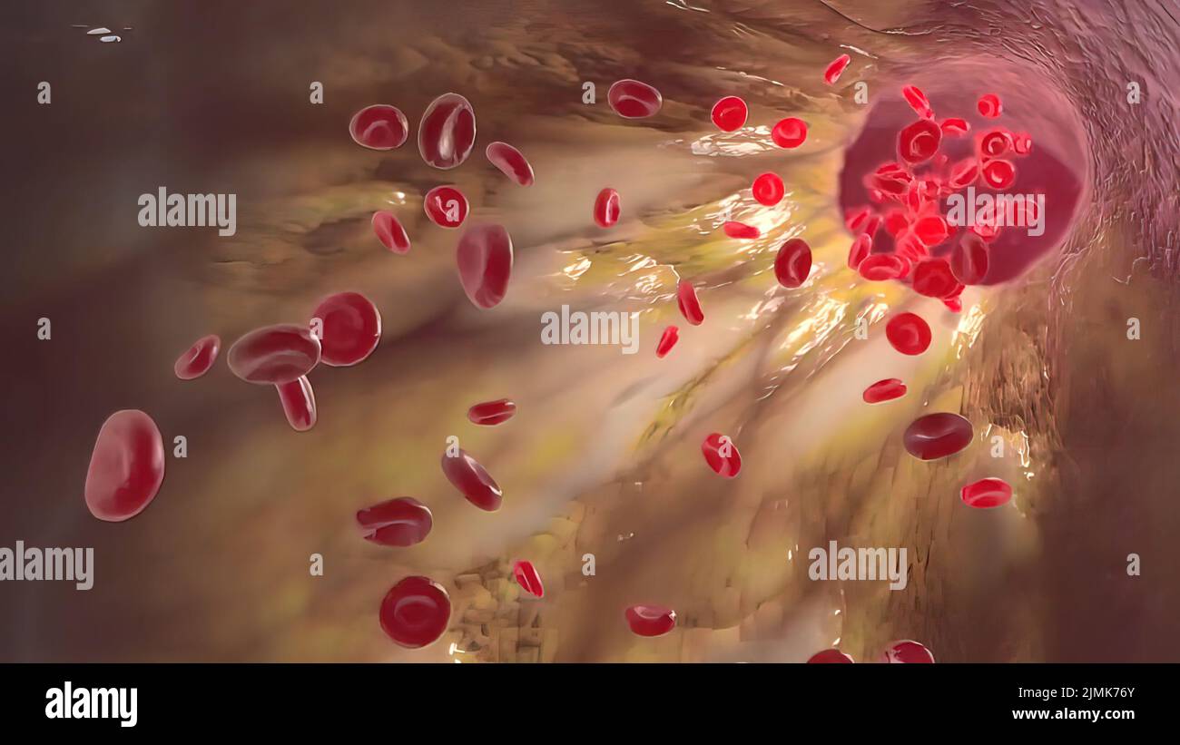 Artery clogging hi-res stock photography and images - Alamy