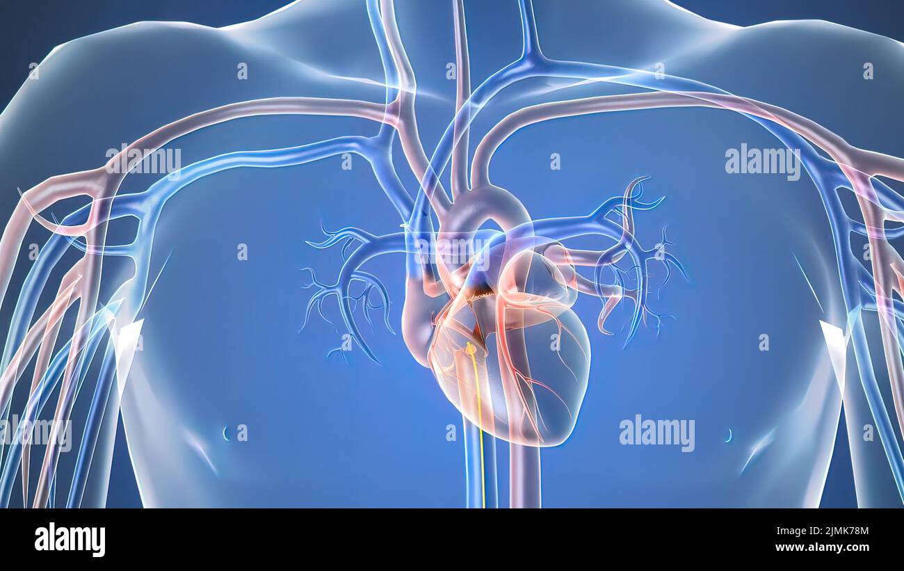 Coronary angiogram stent hi-res stock photography and images - Alamy