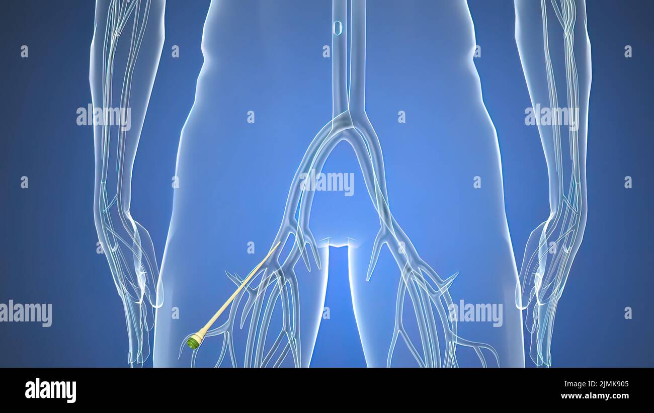 Coronary angiogram stent hi-res stock photography and images - Alamy