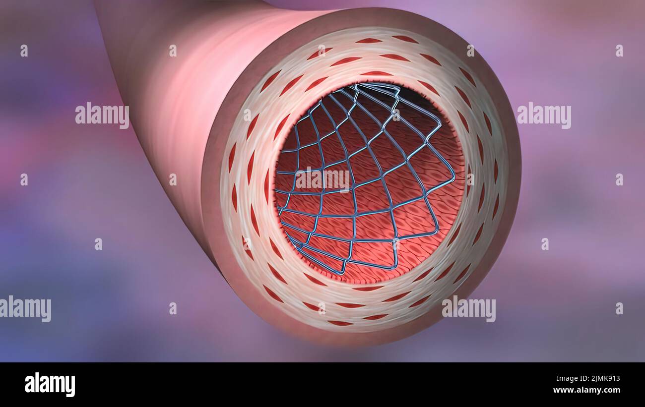 Narrowed coronary arteries hi-res stock photography and images - Alamy