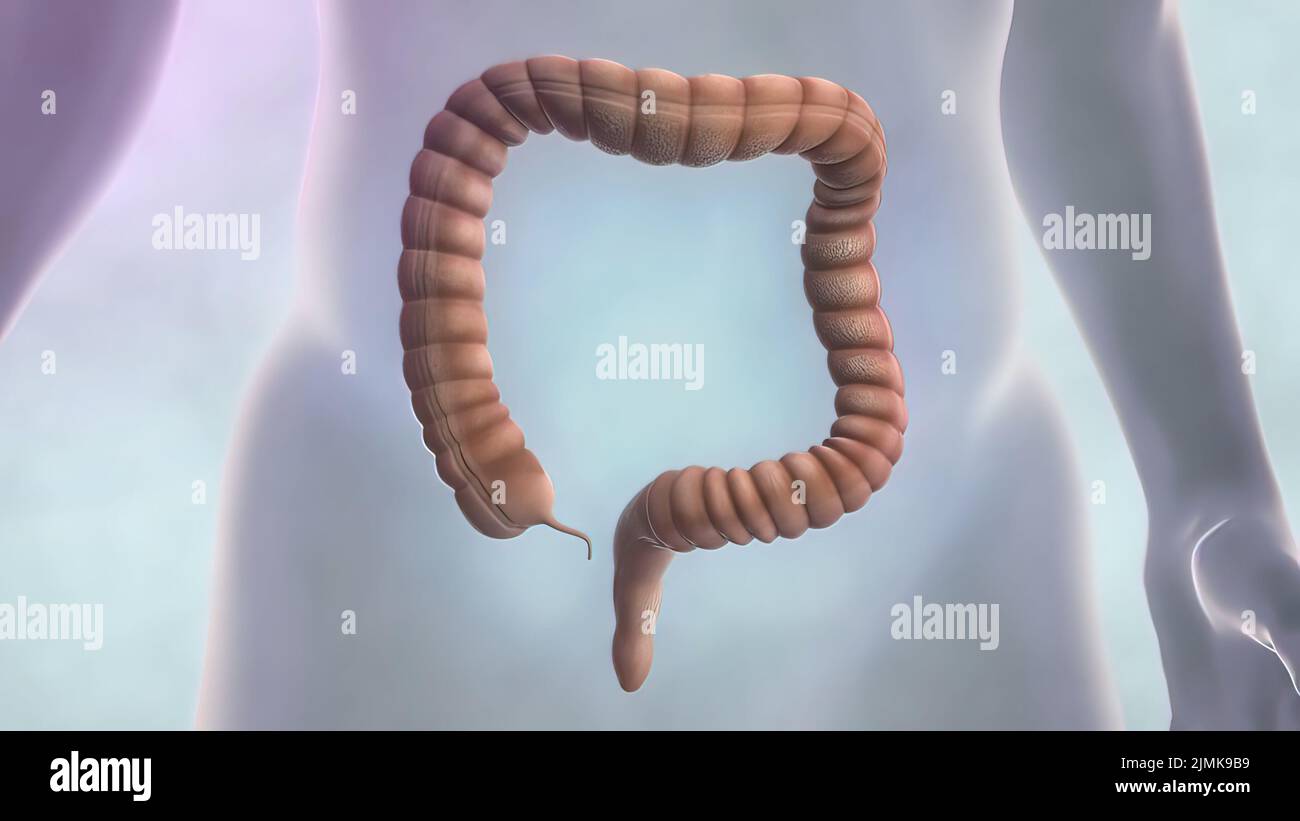 Intestinal polyps hi-res stock photography and images - Alamy