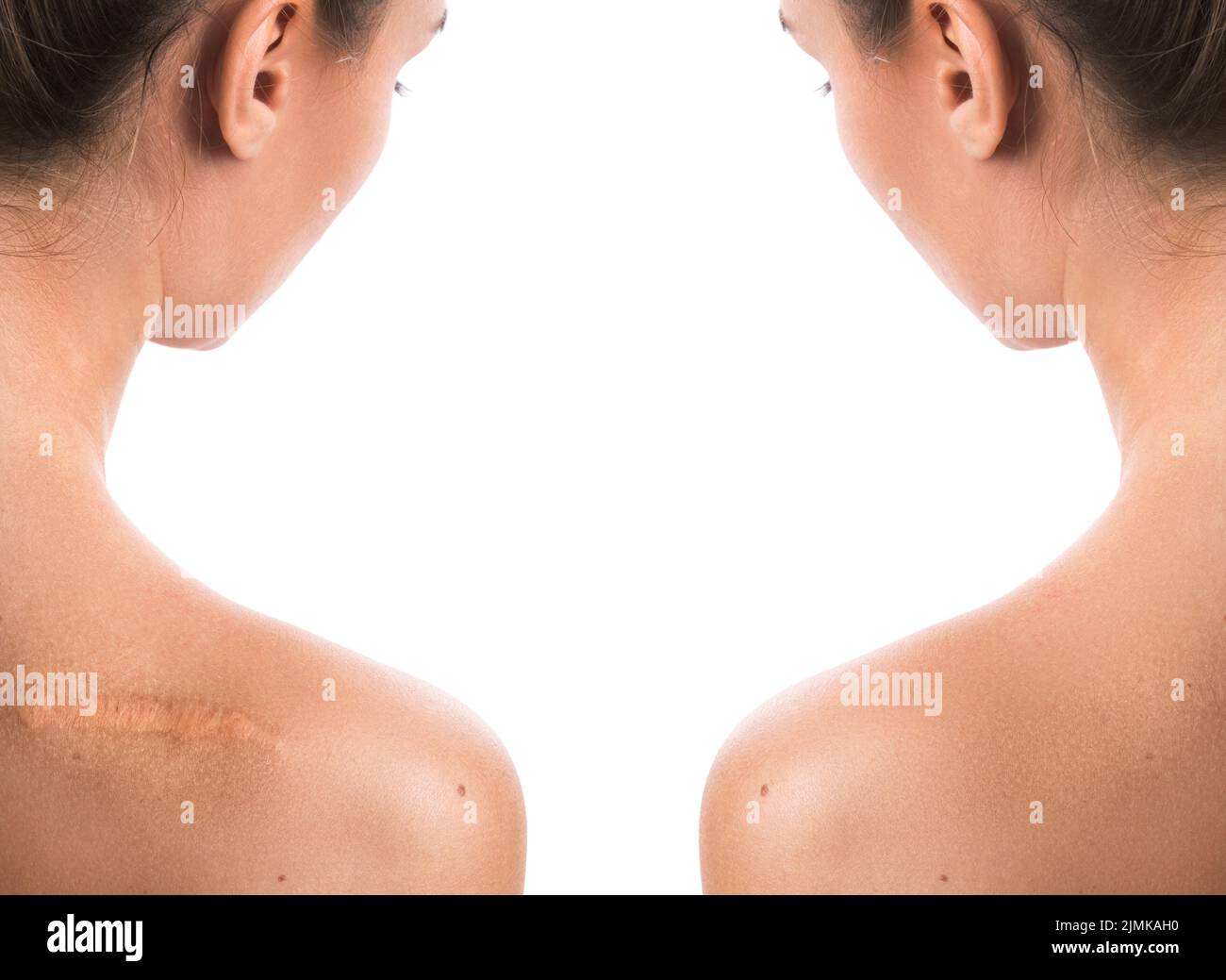 Comparision of female shoulder after scar removing Stock Photo - Alamy