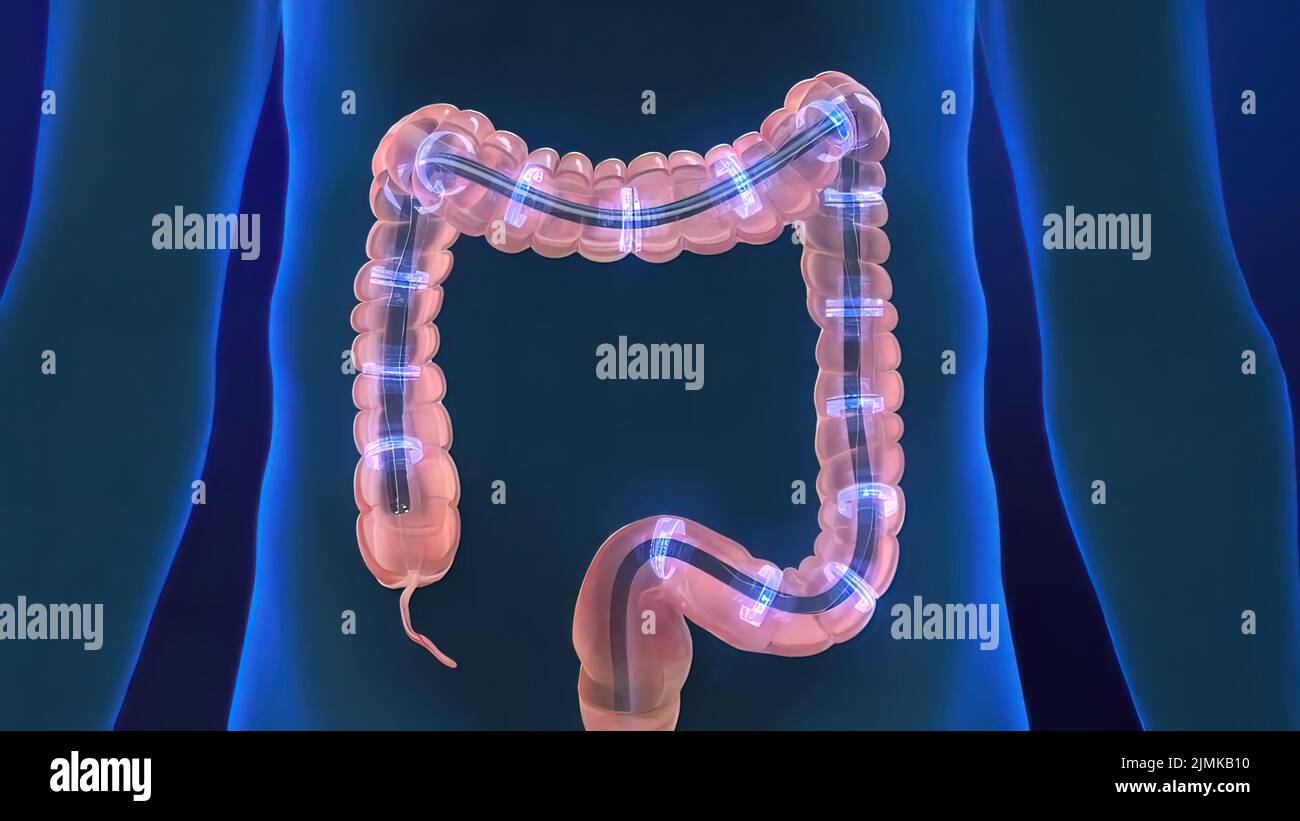 Colonoscopy illustration hi-res stock photography and images - Alamy