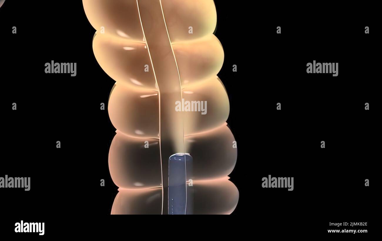 Colonoscopy biopsy hi-res stock photography and images - Alamy