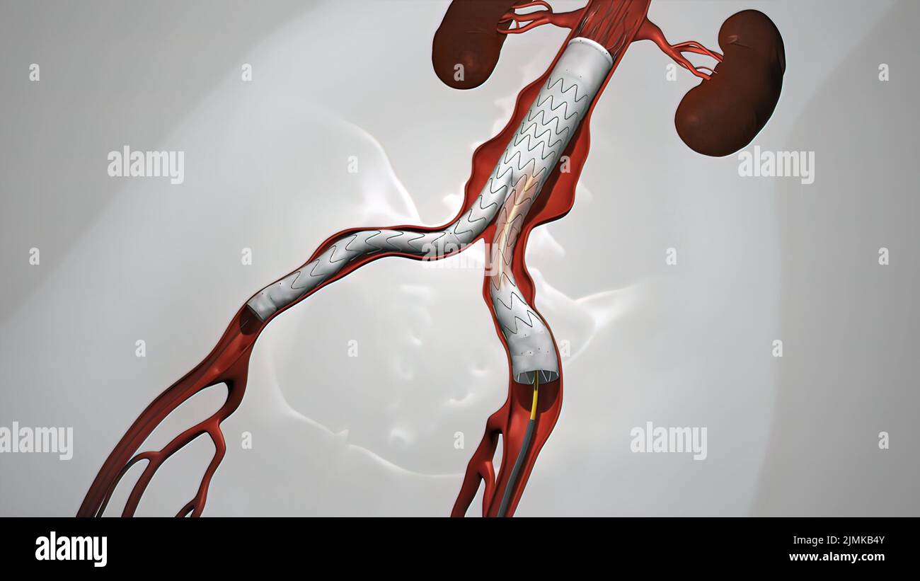 Arteriosclerosis stent procedure hi-res stock photography and images ...