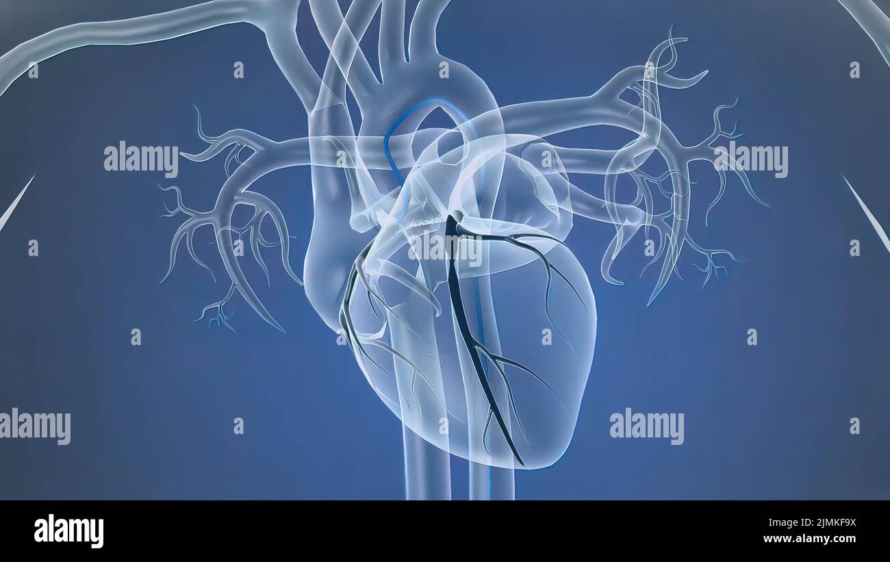 Coronary angiogram stent hi-res stock photography and images - Alamy