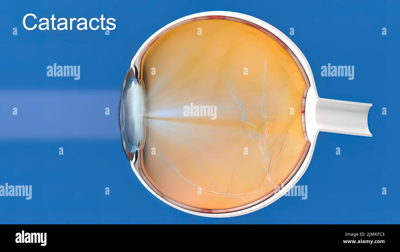 Cataract lens hi-res stock photography and images - Alamy