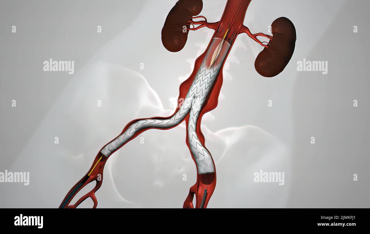 Arteriosclerosis stent procedure hi-res stock photography and images ...