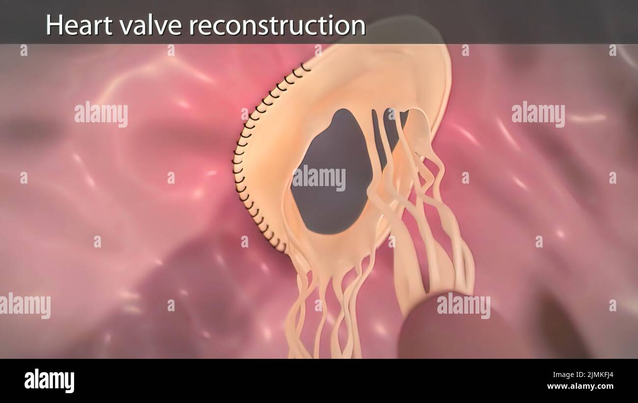 Cardiac surgery wound hi-res stock photography and images - Alamy