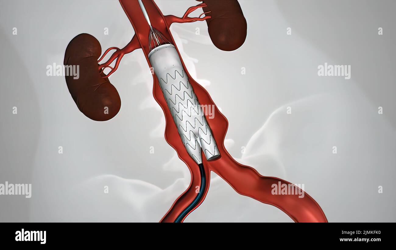 Arteriosclerosis stent procedure hi-res stock photography and images ...