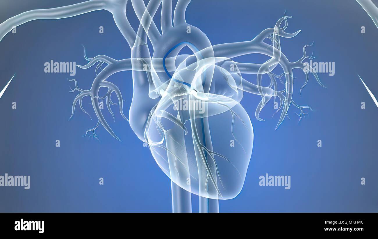 Coronary angiogram stent hi-res stock photography and images - Alamy