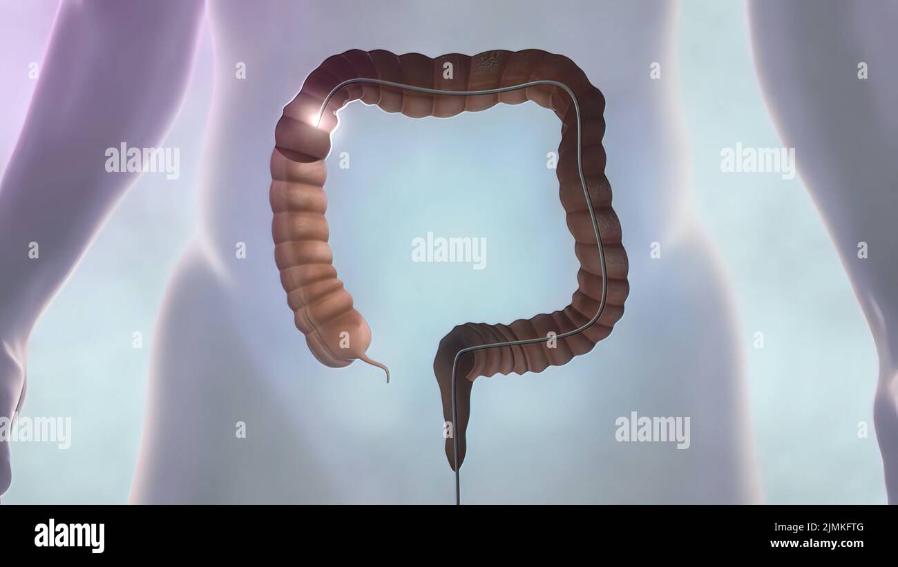 Intestinal polyps hi-res stock photography and images - Alamy