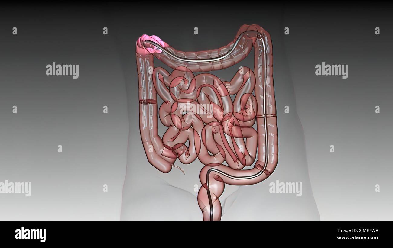 Large intestine camera hi-res stock photography and images - Alamy