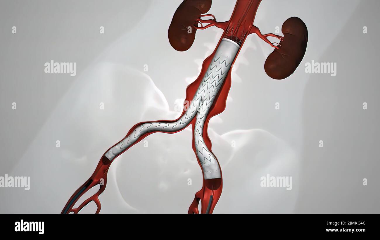 Coronary artery bypass procedure hi-res stock photography and images ...