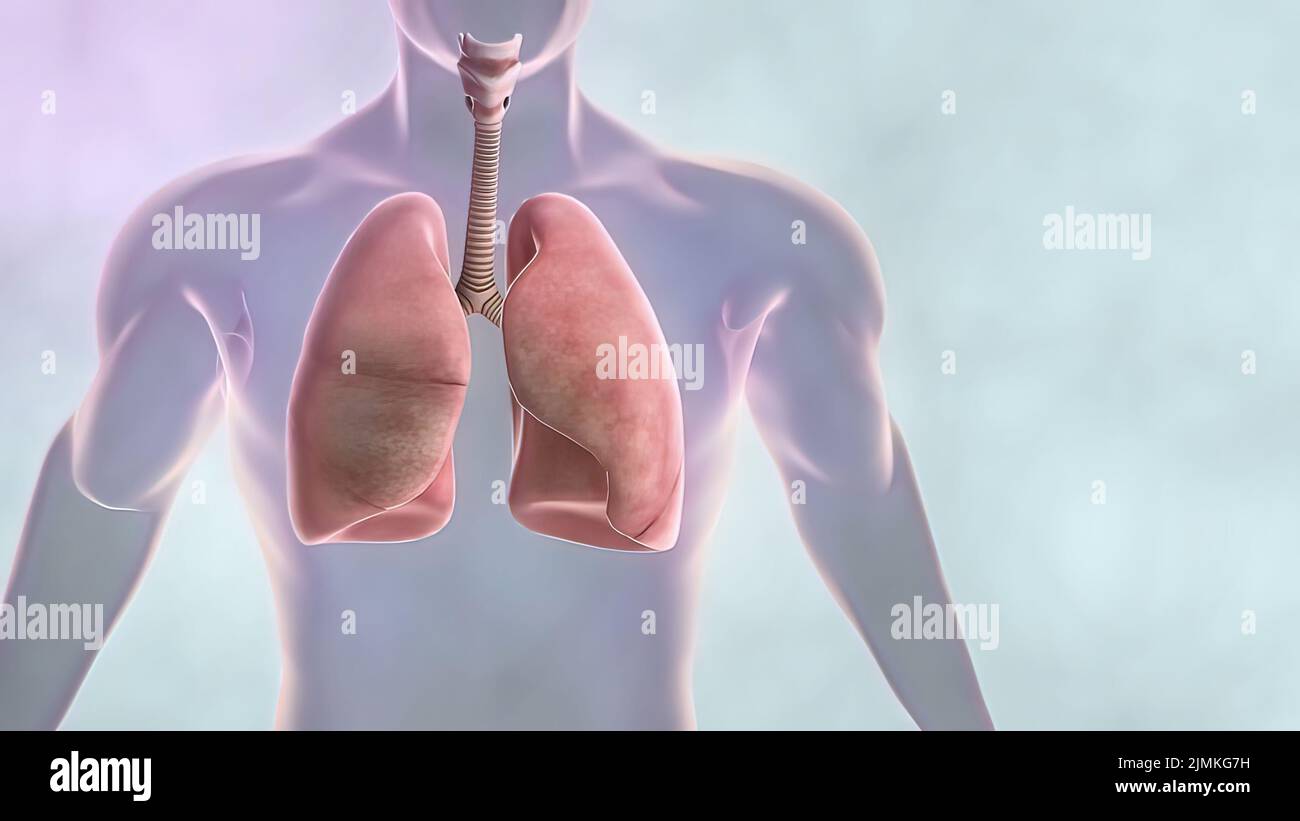 Stages of cancer hi-res stock photography and images - Alamy