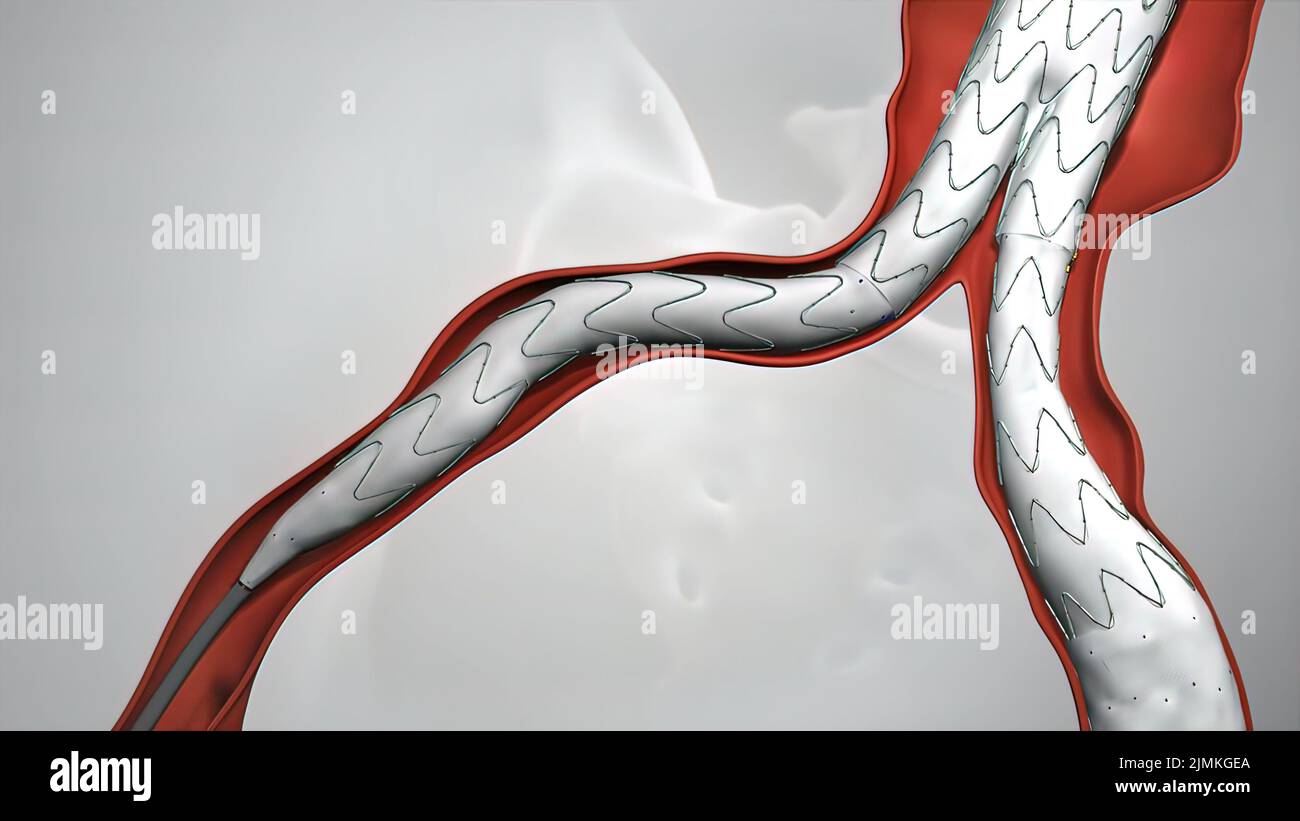 Coronary artery bypass procedure hi-res stock photography and images ...