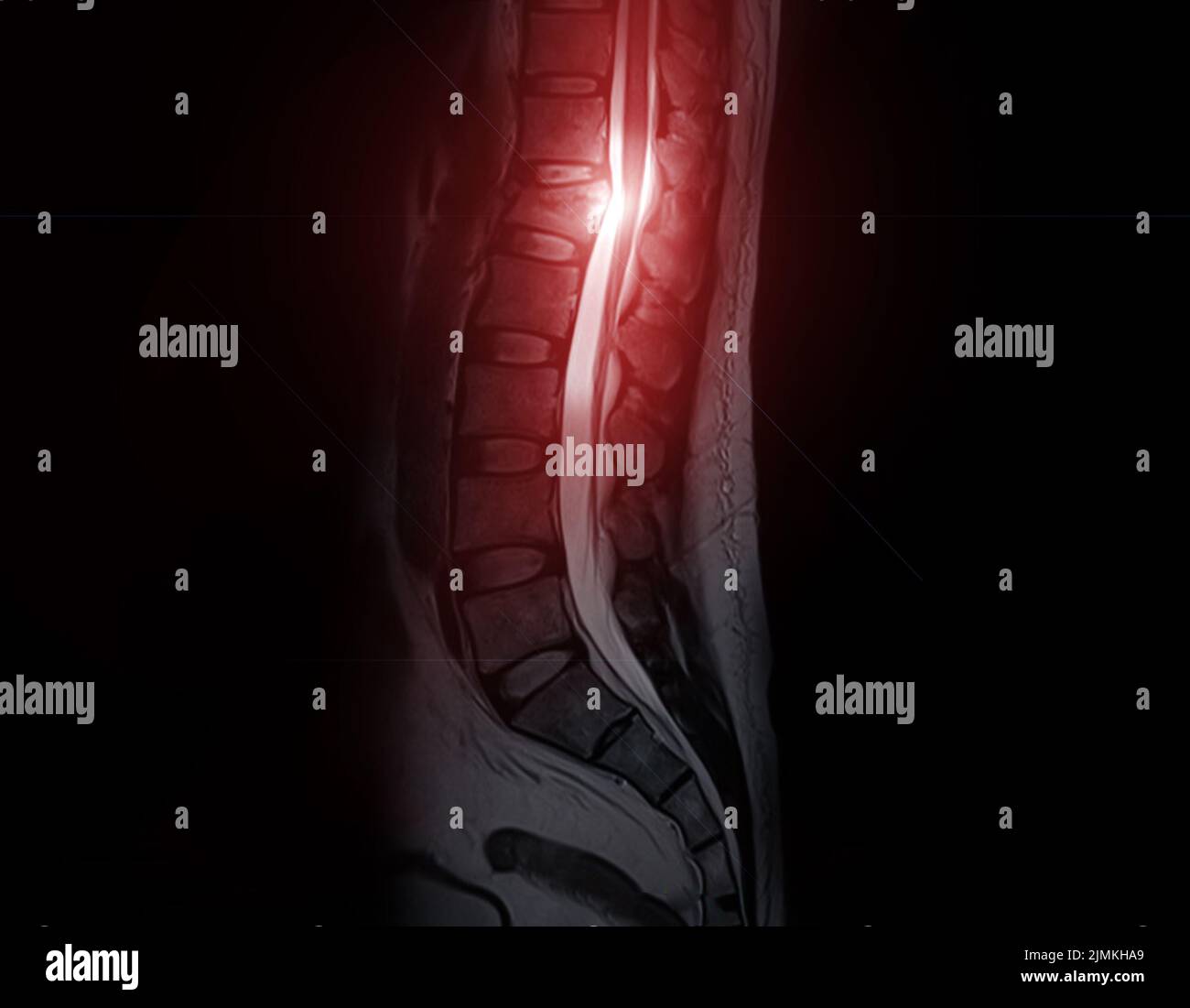MRI Lumbar spine sagittal T2W Fat suppression Stock Photo - Alamy