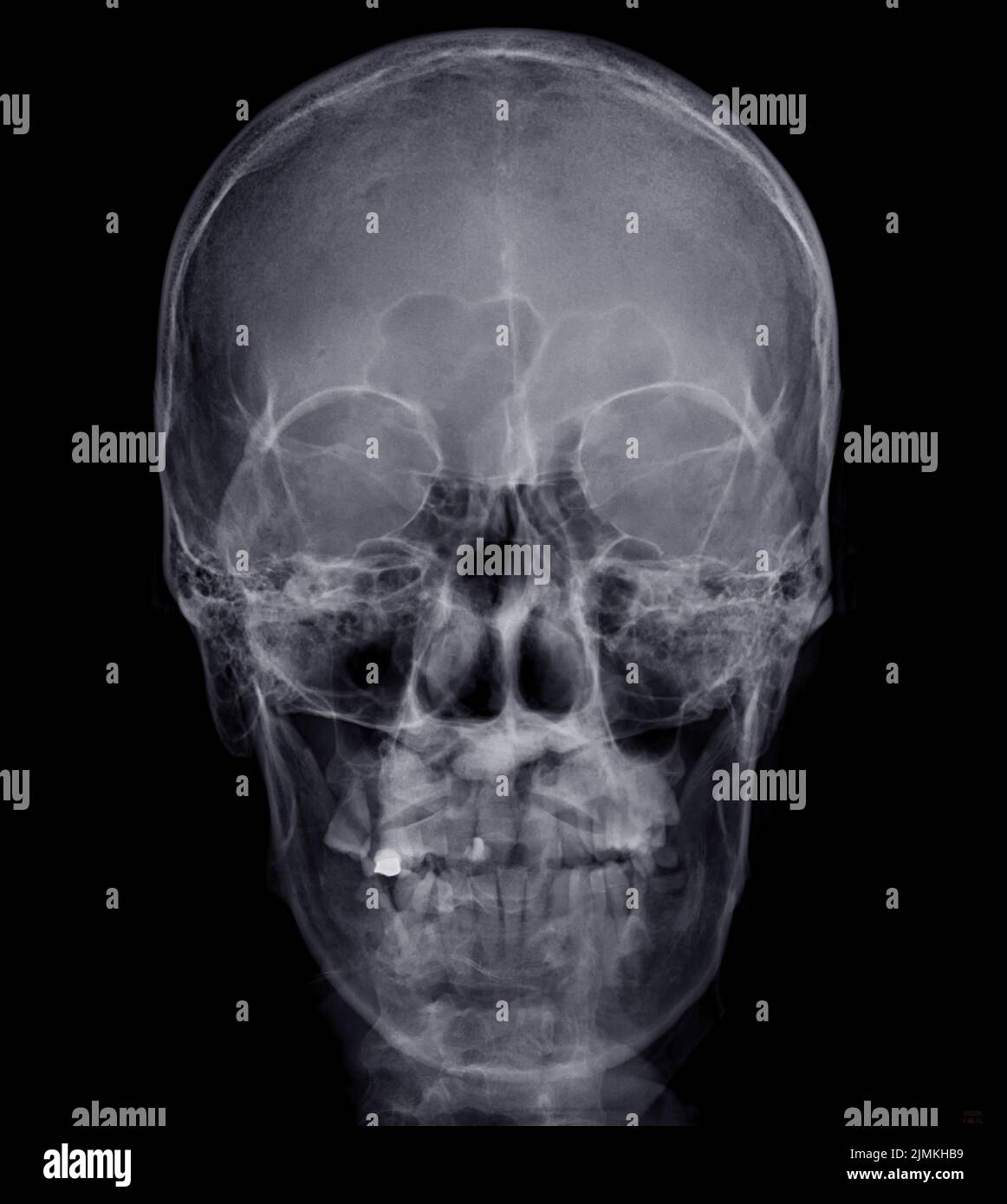 Skull x-ray image of Human name is skull AP view .isolated on Black ... Skull x-ray image of Human name is skull AP view .isolated on Black ...