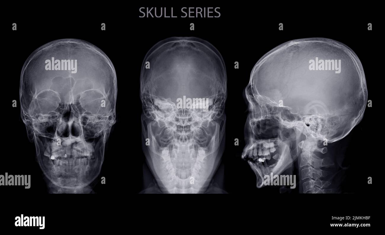 Collection of Skull x-ray image name is skull series isolated on Black ...