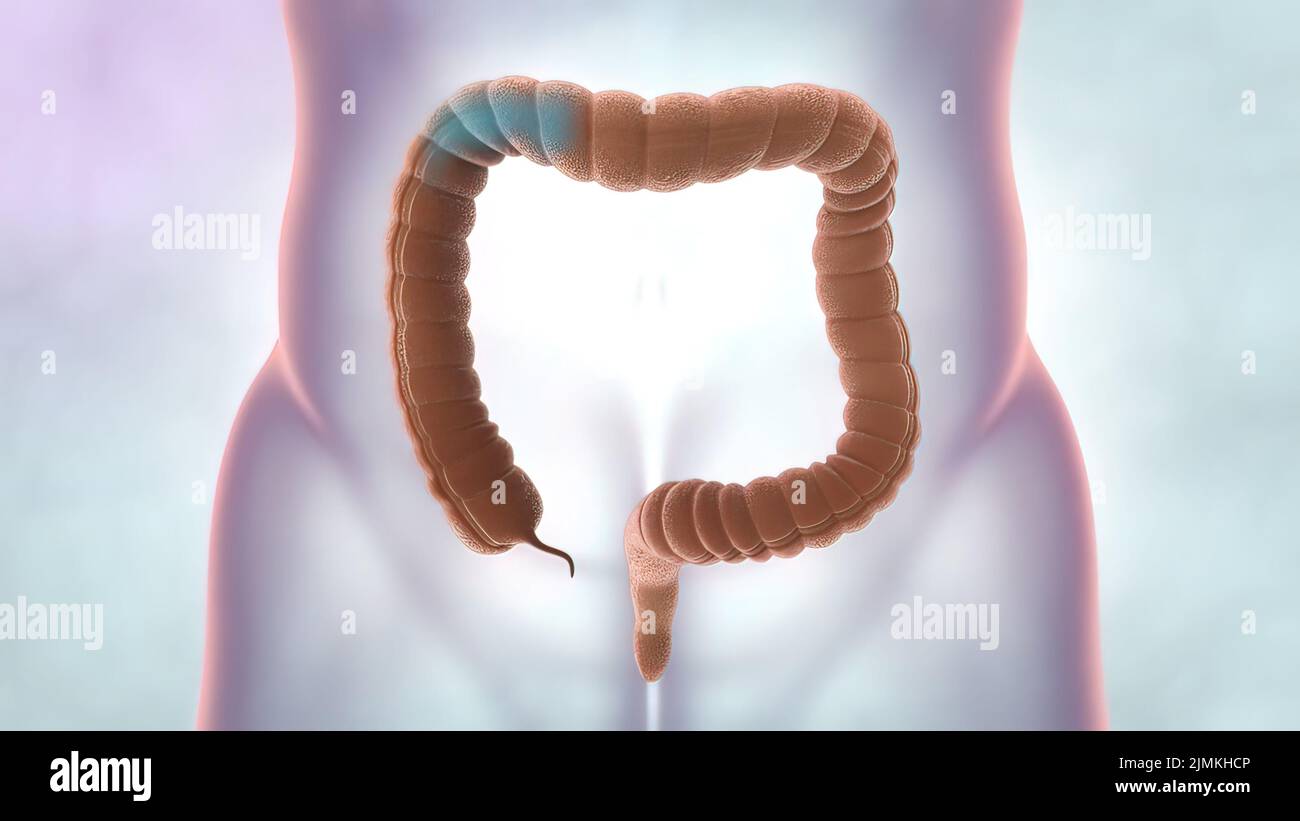 Inflamed intestines hi-res stock photography and images - Alamy