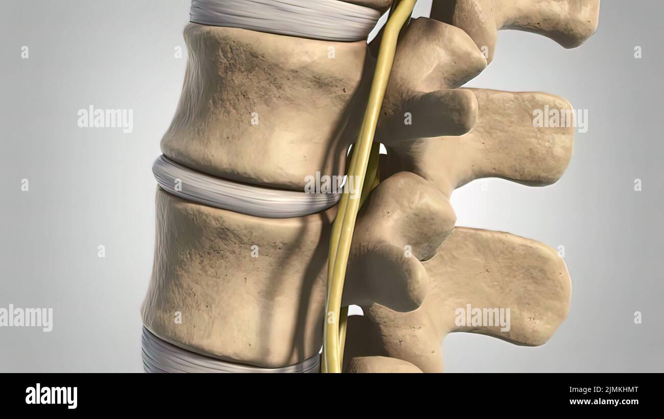 Spinal disorder hi-res stock photography and images - Alamy