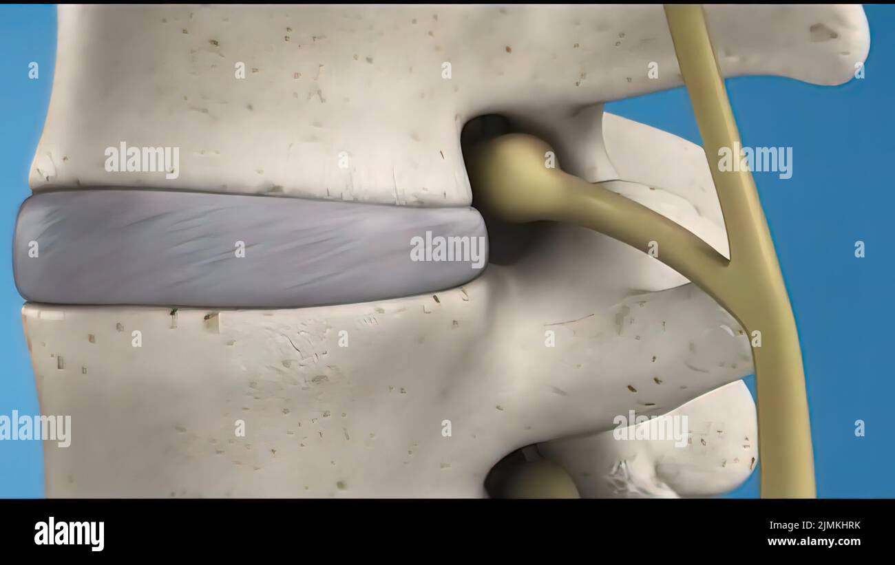 Lumbar vertebra compress hi-res stock photography and images - Alamy