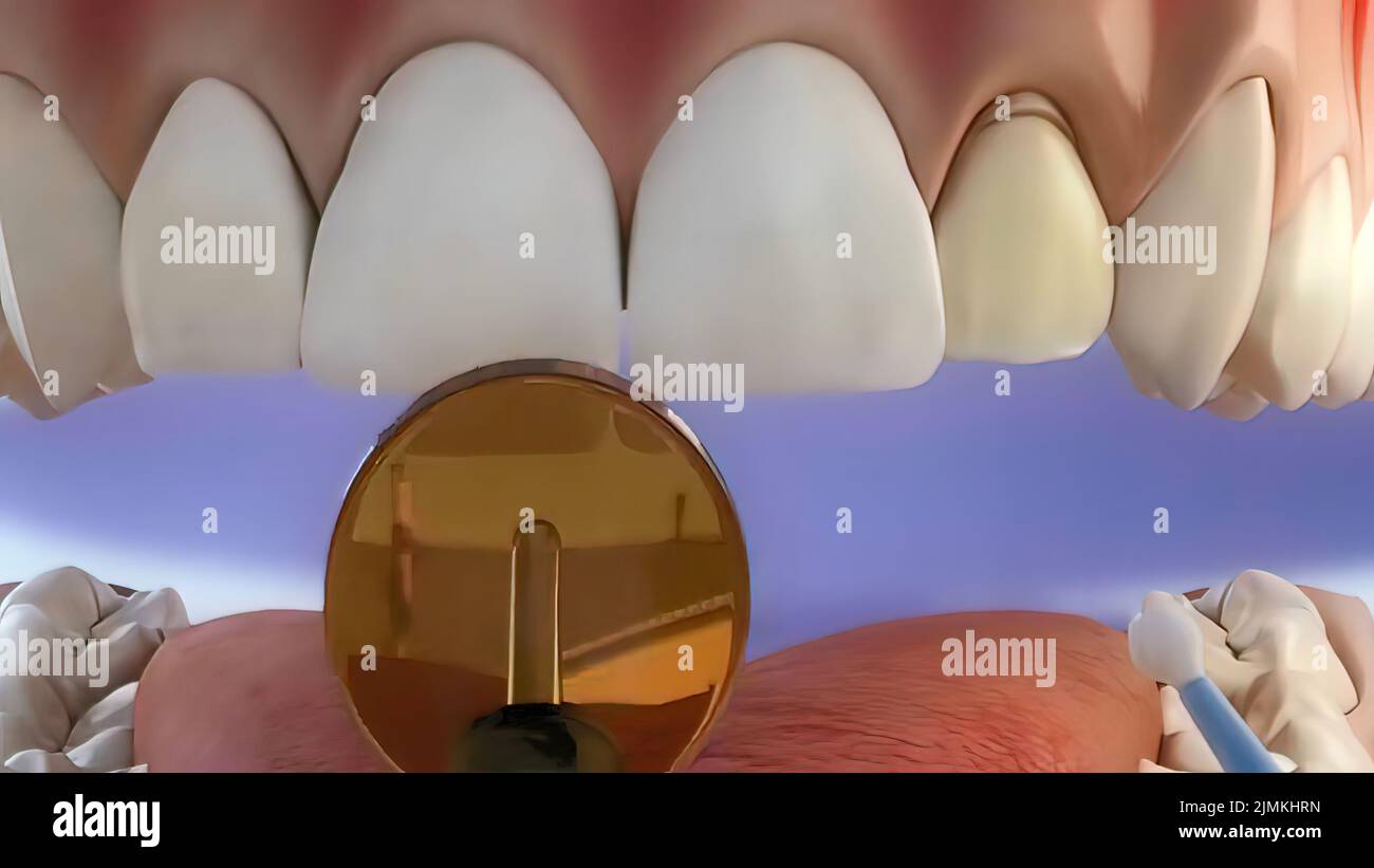 Tooth coating hi-res stock photography and images - Alamy