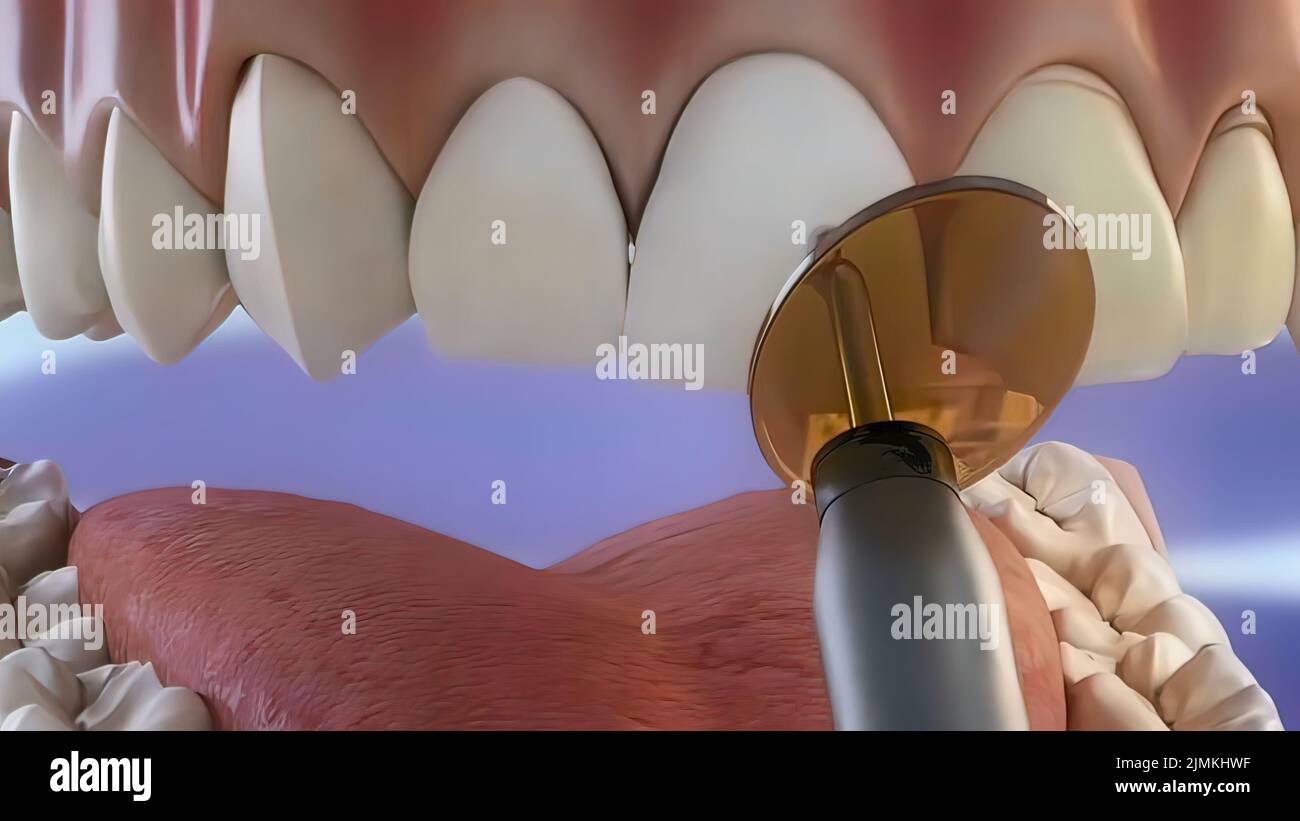 Tooth coating hi-res stock photography and images - Alamy