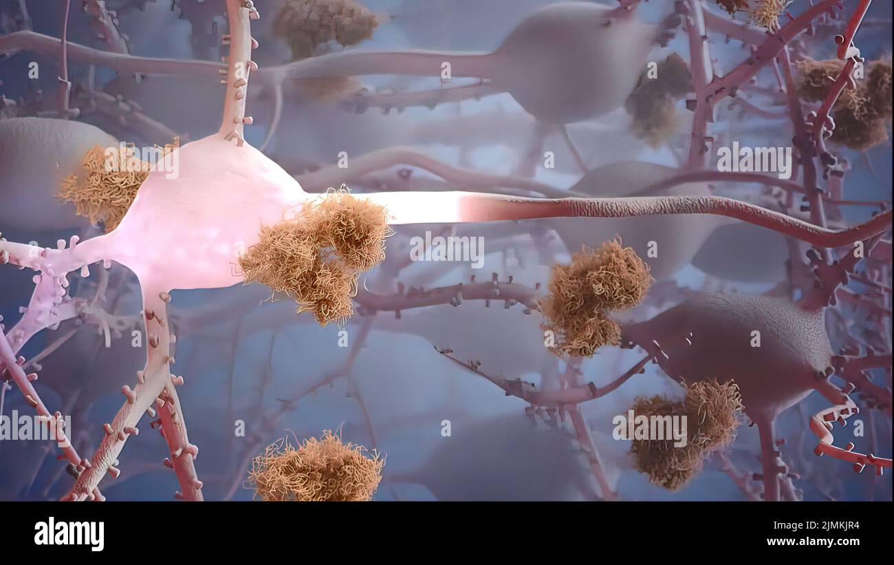 Alzheimer’s brain scan hi-res stock photography and images - Alamy