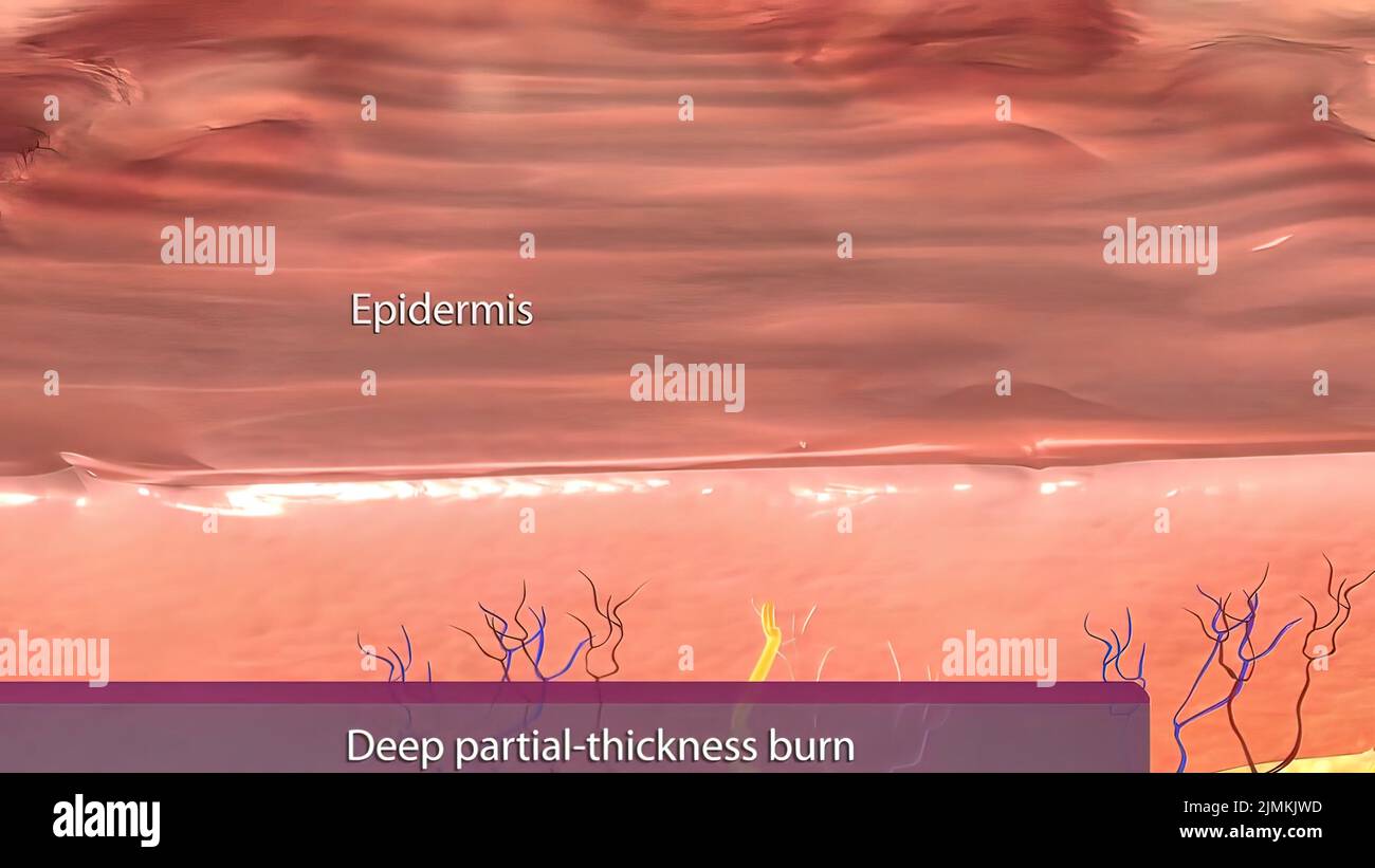 Dermal infection hi-res stock photography and images - Alamy