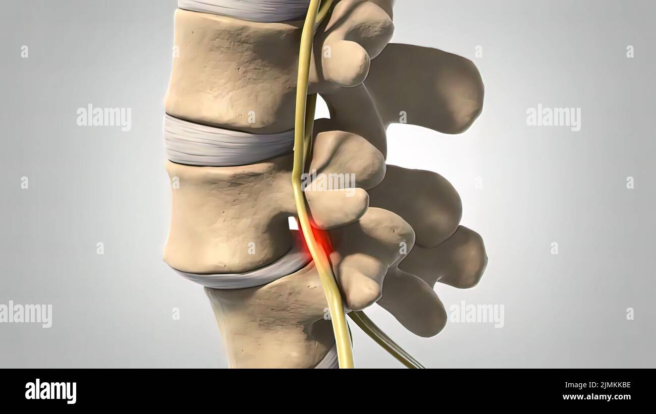 Degenerative disk hi-res stock photography and images - Alamy