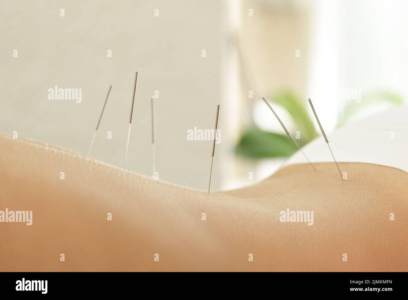 Female back with steel needles during procedure of acupuncture therapy ...