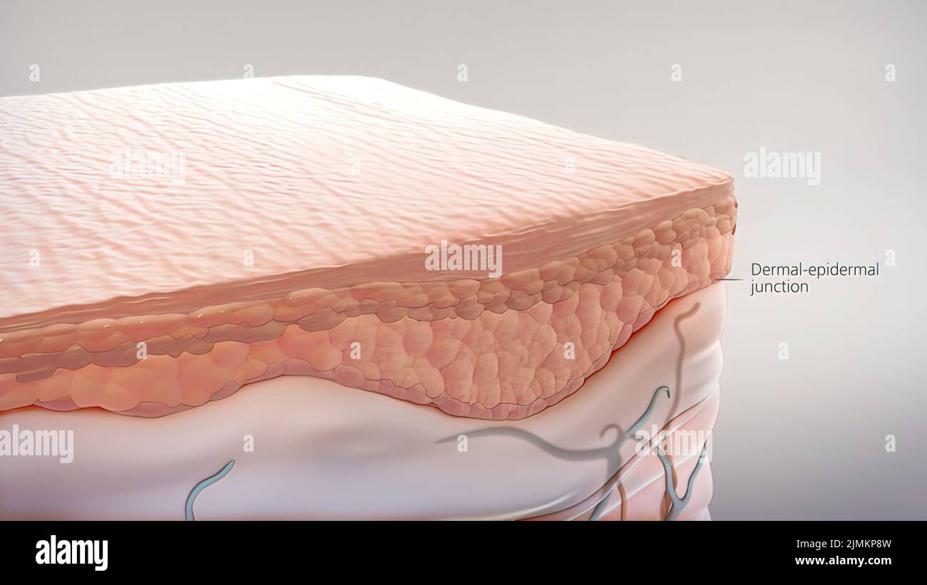 Thermal burn skin hi-res stock photography and images - Alamy