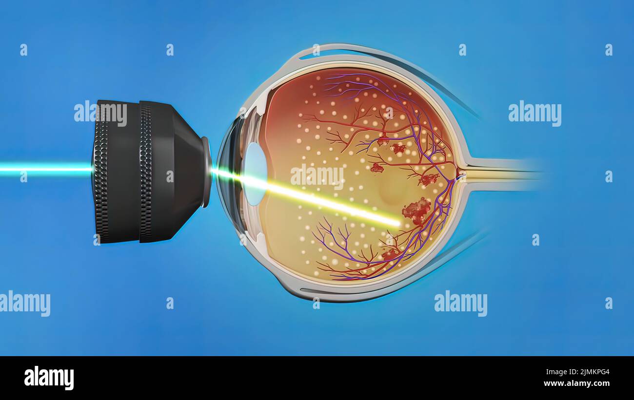 Laser surgery eye hi-res stock photography and images - Alamy