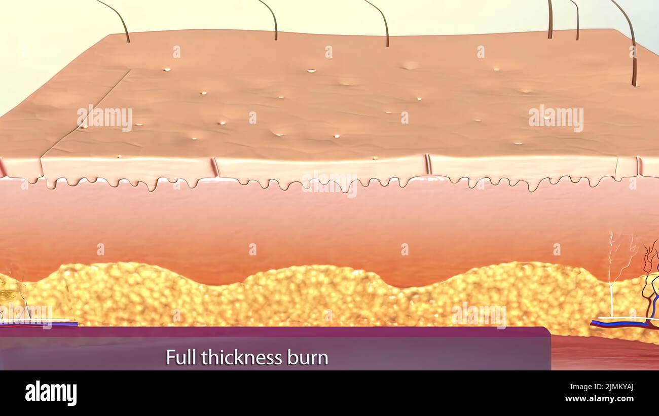 Full thickness burns hi-res stock photography and images - Alamy