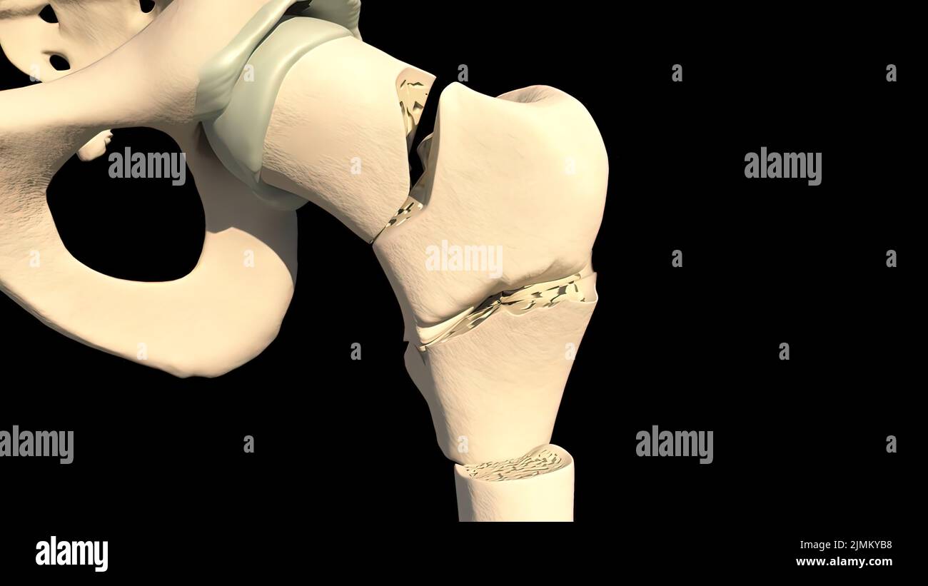 Tibia fracture illustration hi-res stock photography and images - Alamy