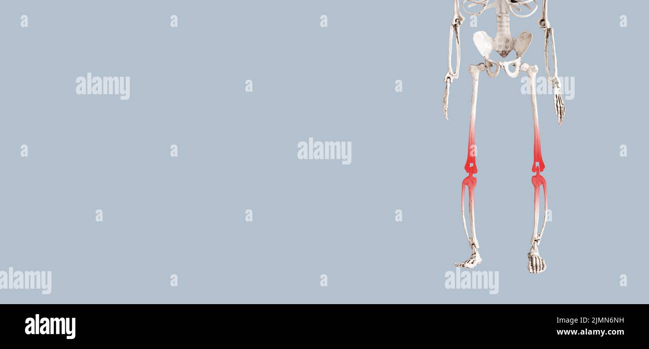 Banner with skeleton with red points at painful knees. Arthritis ...