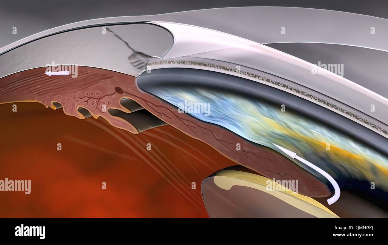 Glaucoma anterior chamber hi-res stock photography and images - Alamy
